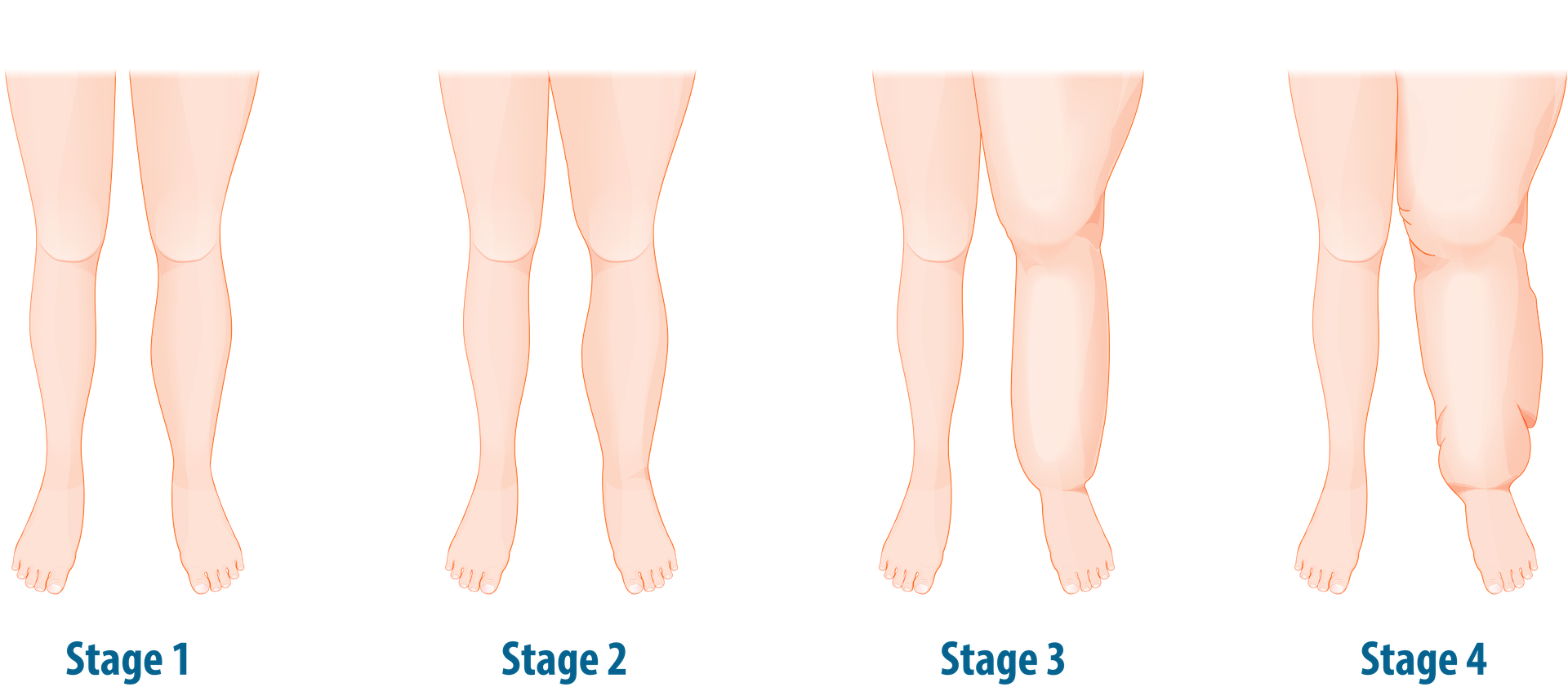 Lymphedema Causes, Types & Treatments